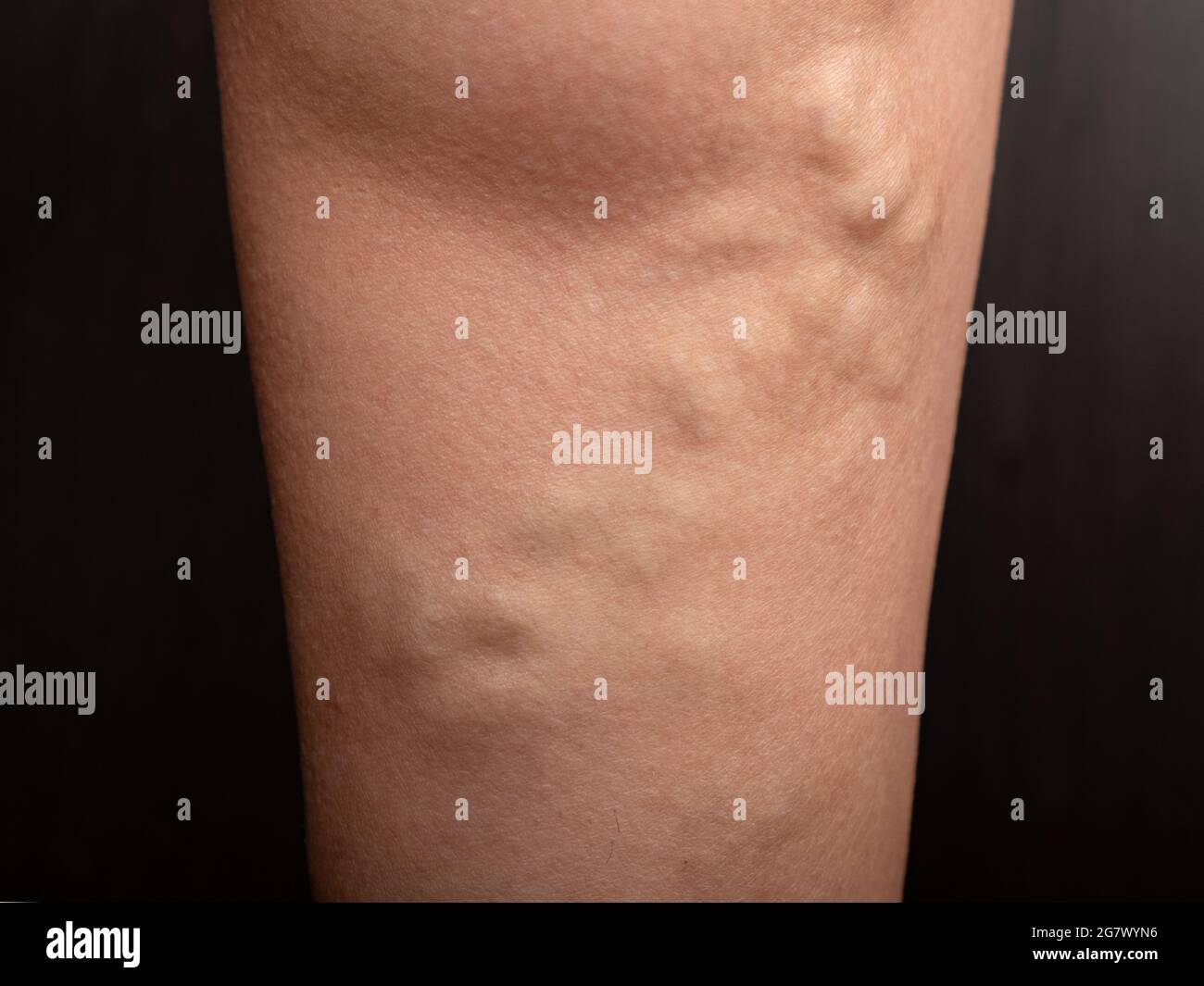 Phlebitis hi-res stock photography and images - Alamy