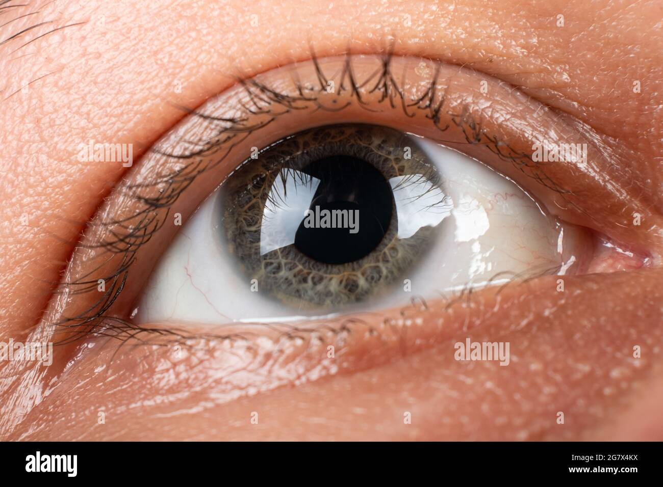 Keratoconus eye closeup , thinning of the cornea Stock Photo - Alamy