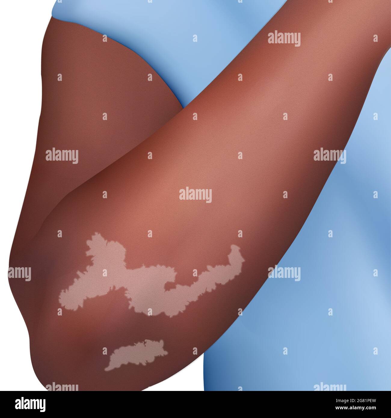 Dermatology disease hi-res stock photography and images - Alamy