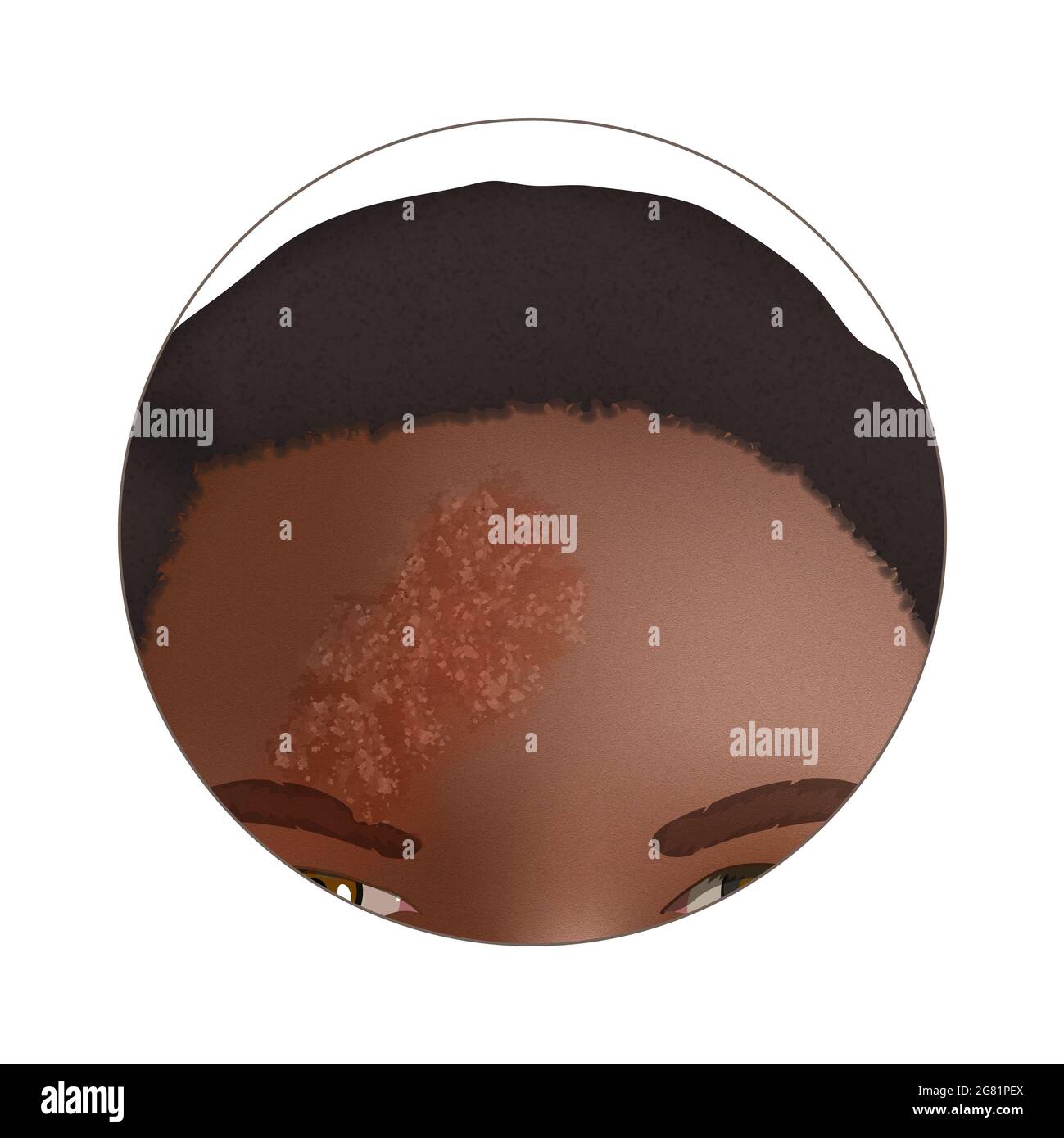 Shingles rash, illustration Stock Photo - Alamy