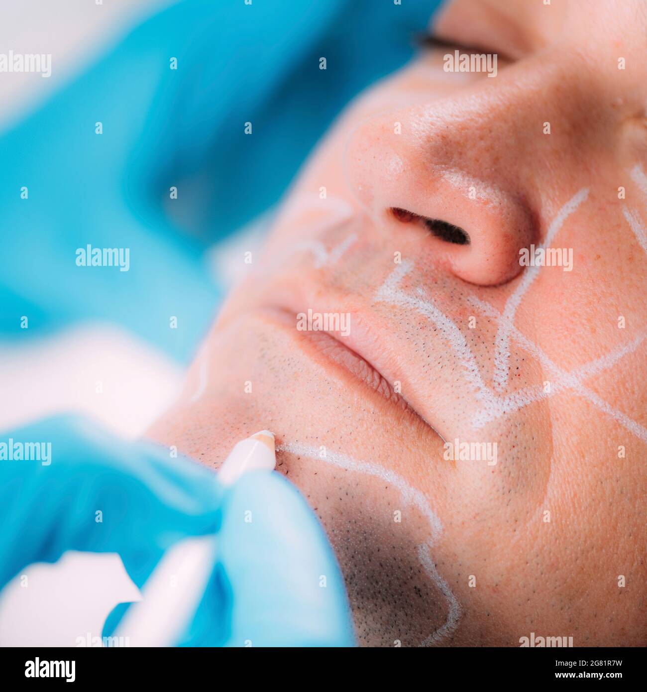 Marking face before filler treatment Stock Photo - Alamy