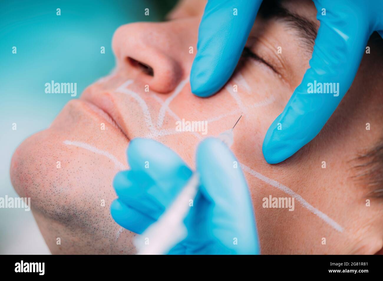 Dermal cheek filler injection for men Stock Photo - Alamy