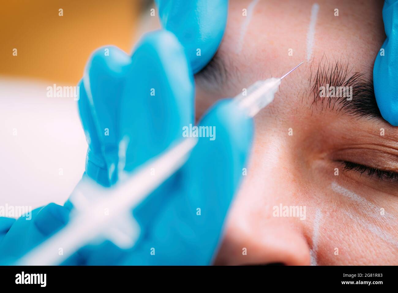 Dermal filler injection for men Stock Photo - Alamy