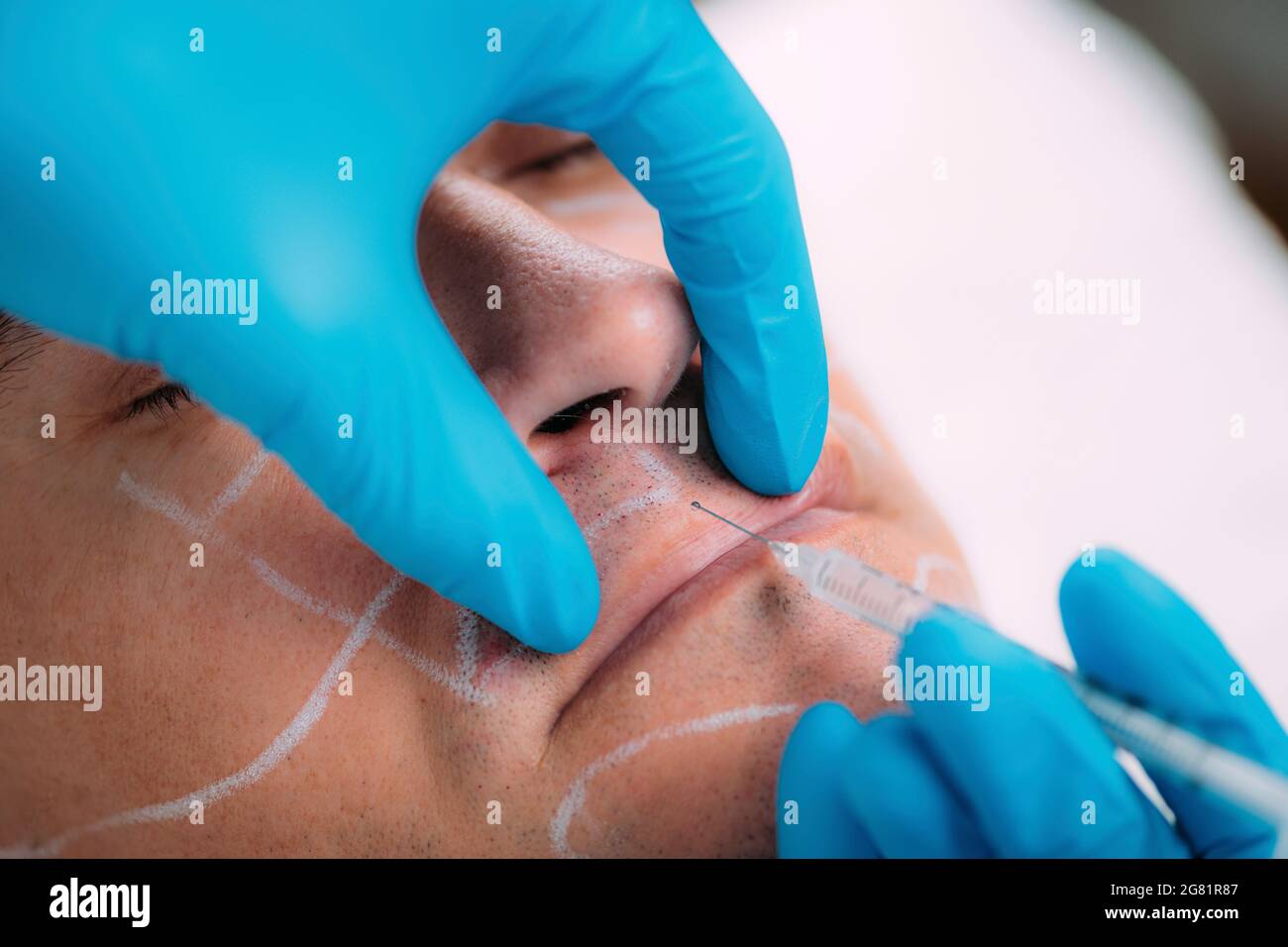 Dermal filler beauty treatment Stock Photo - Alamy