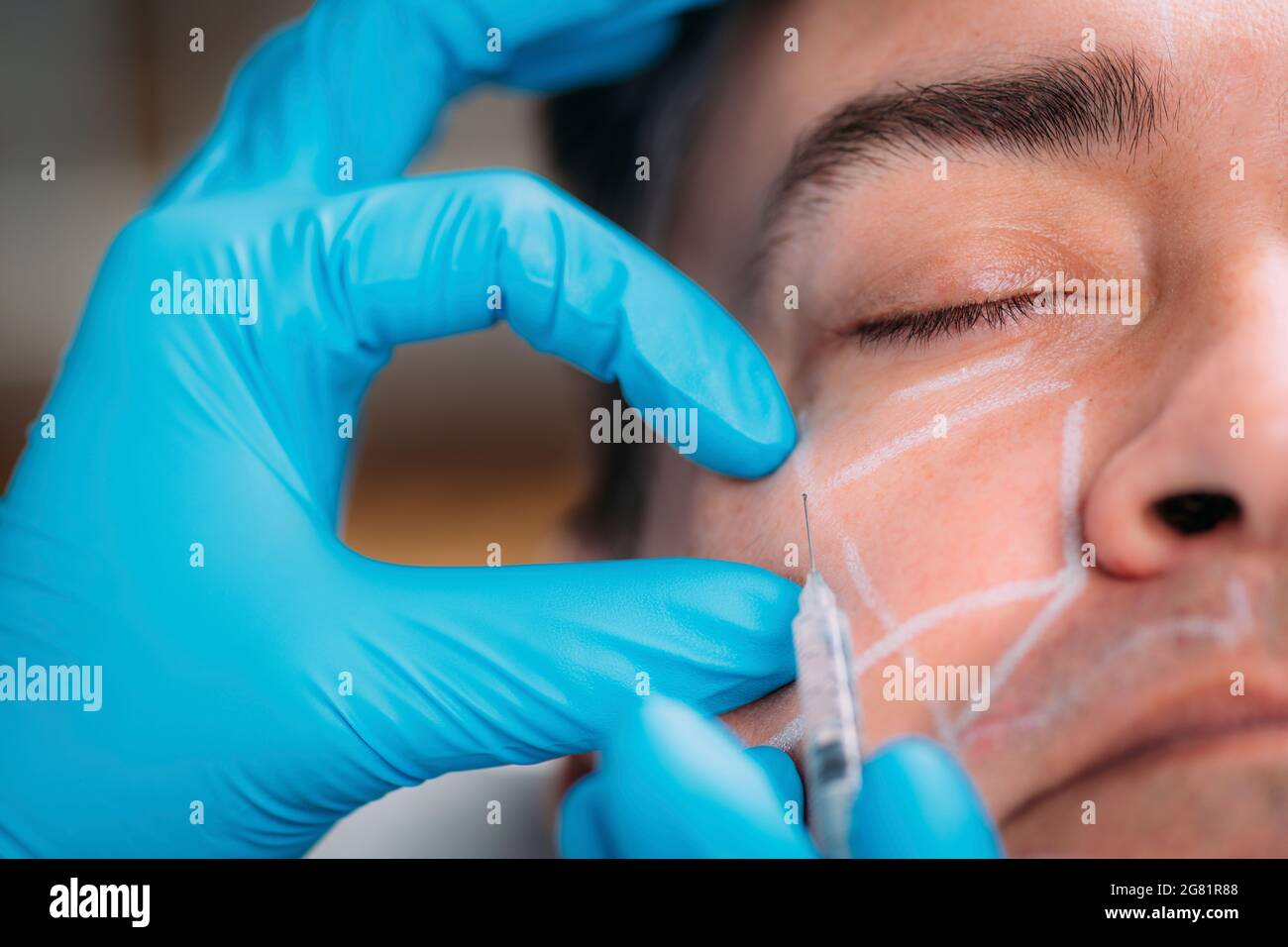 Dermal filler injection Stock Photo - Alamy