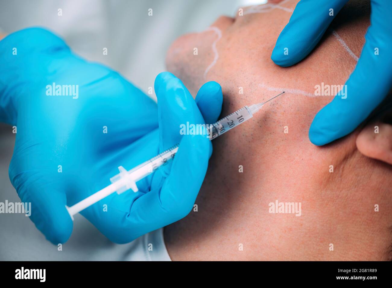 Dermal fillers jawline injection Stock Photo - Alamy