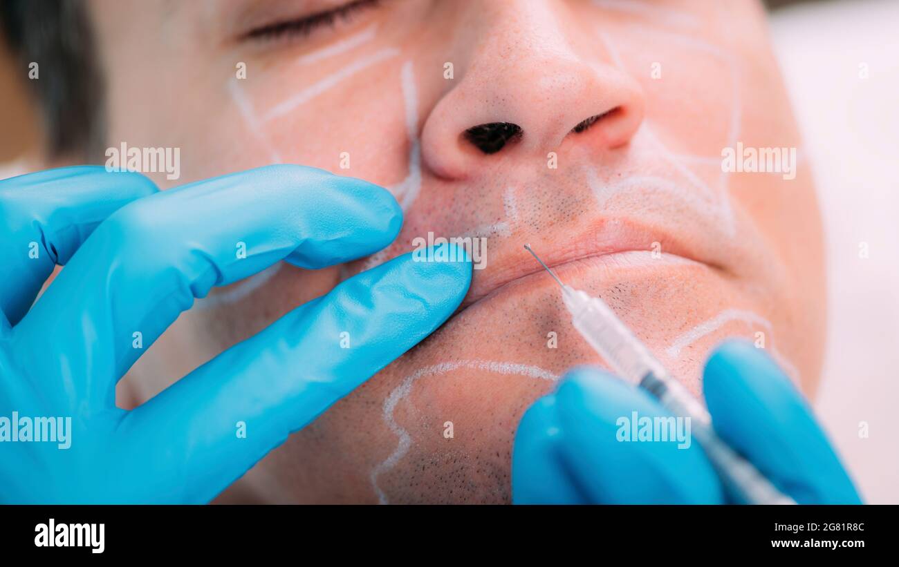 Dermal filler beauty treatment Stock Photo - Alamy