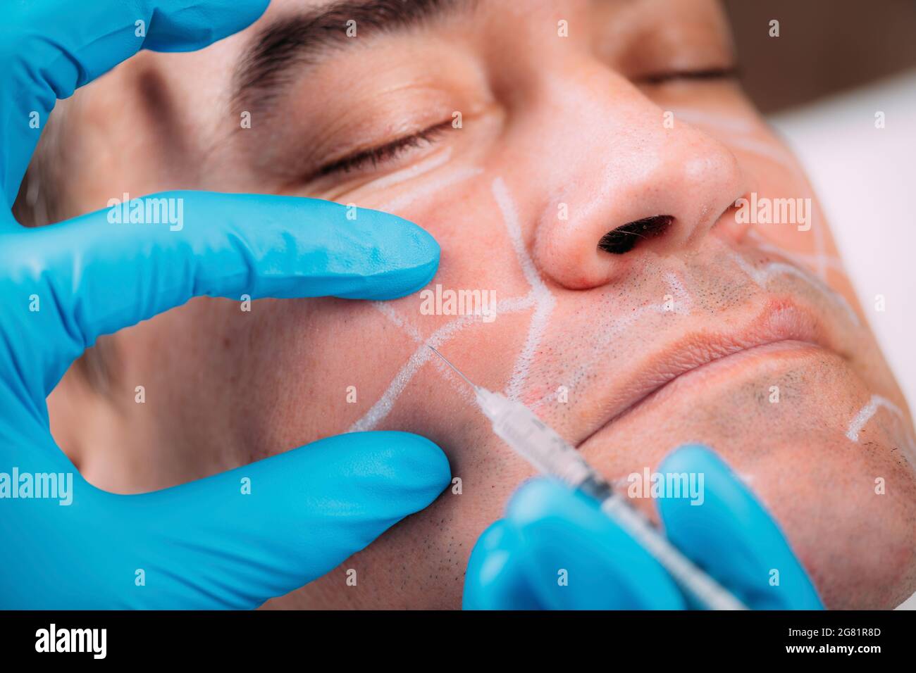 Close up filler injection hi-res stock photography and images - Alamy
