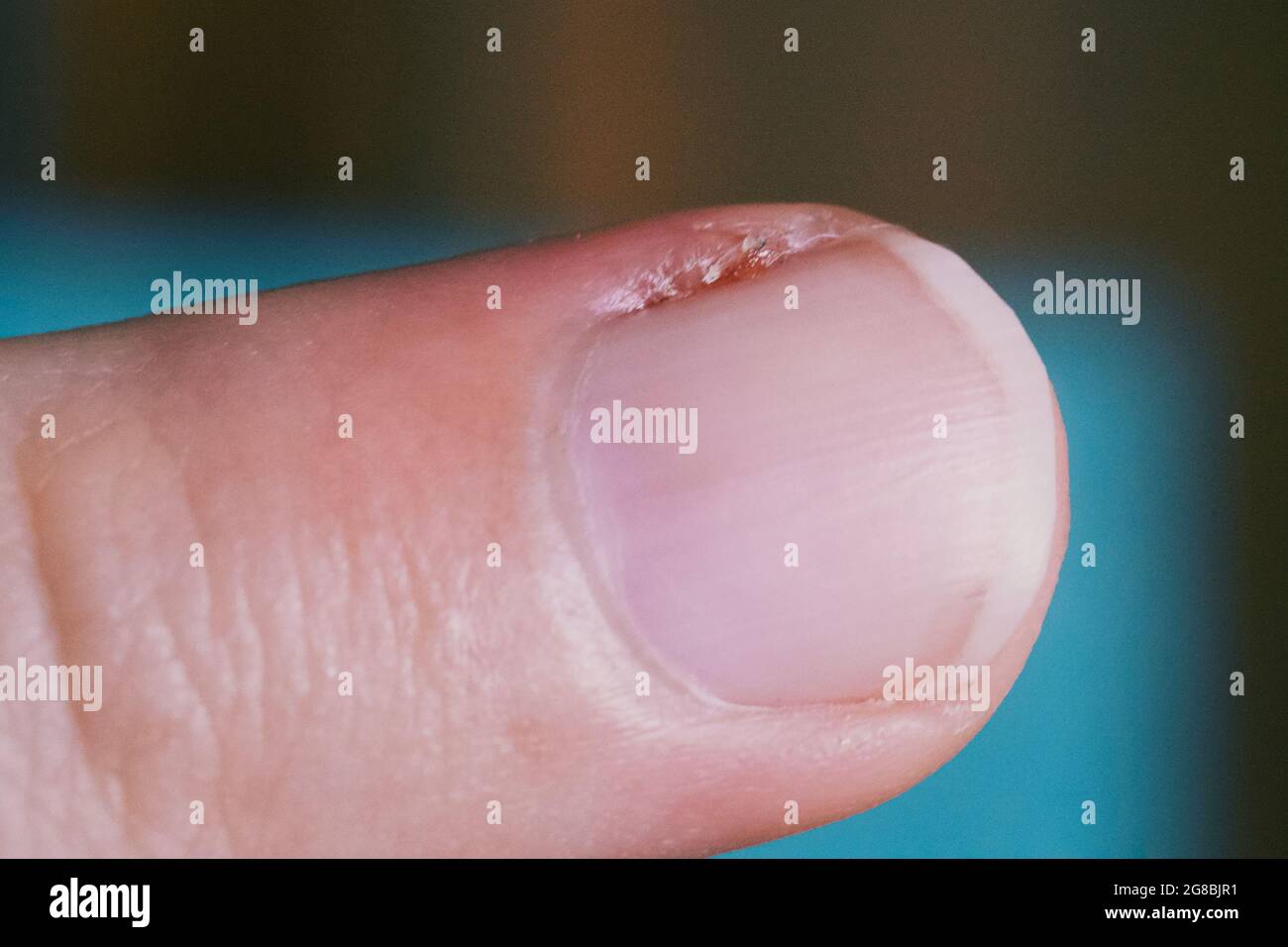 Inflamed cuticle on the finger. Damaged part of the finger, close-up ...