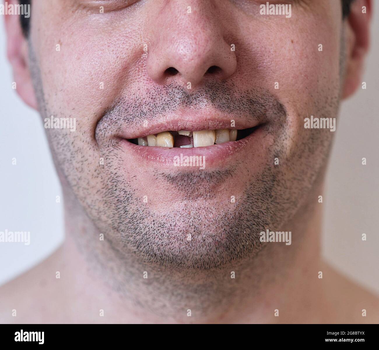 portrait of a man with broken teeth Stock Photo - Alamy