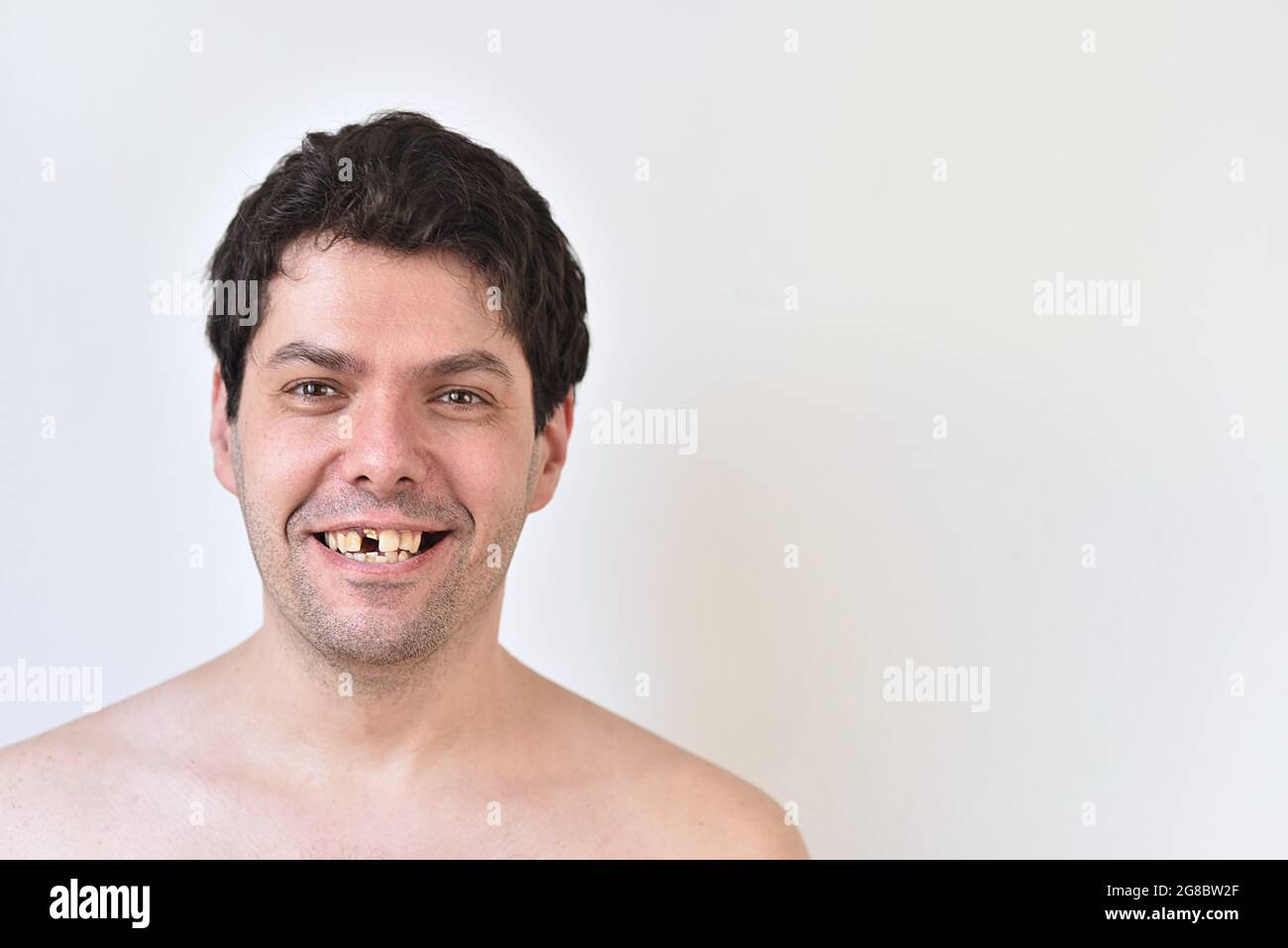 Broken teeth hi-res stock photography and images - Alamy