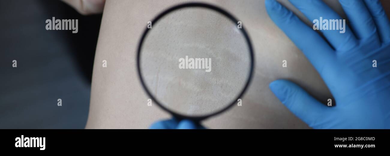 Doctor examining stretch marks on patients back using magnifying glass ...