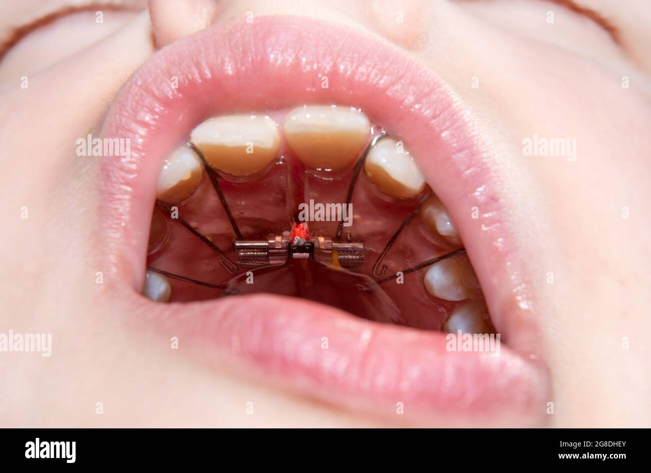 Teeth. Dental treatment. Open mouth with teeth alignment plate. A child ...