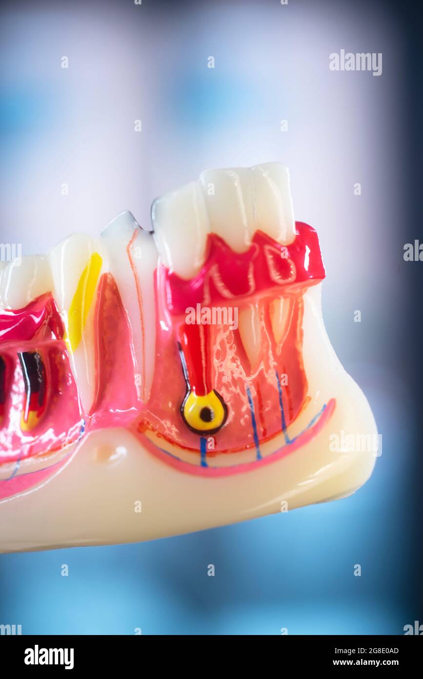 Tooth decay dentists dental model of teeth, gums and root canal Stock ...