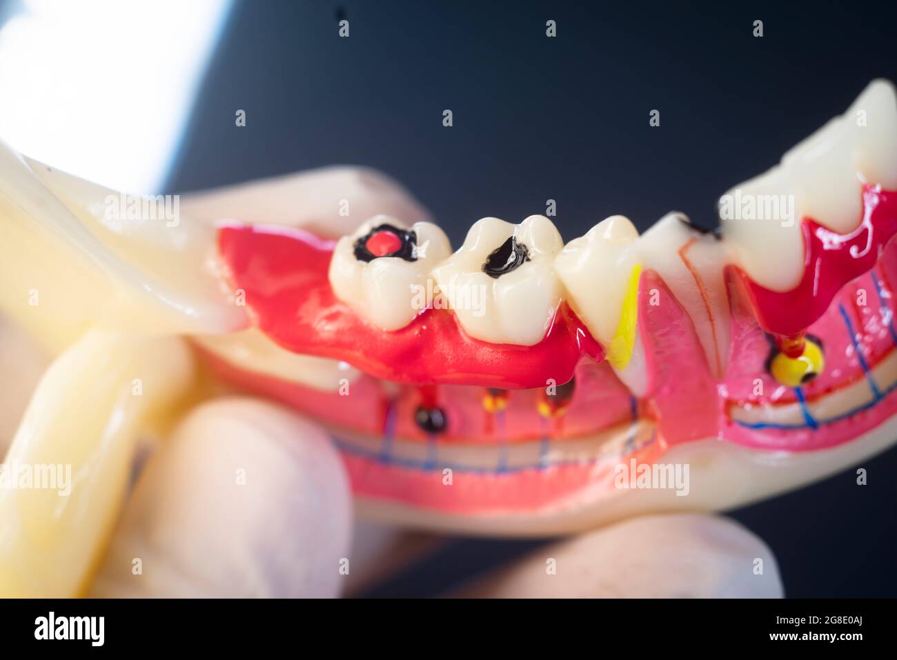 Decayed tooth root canal hi-res stock photography and images - Alamy