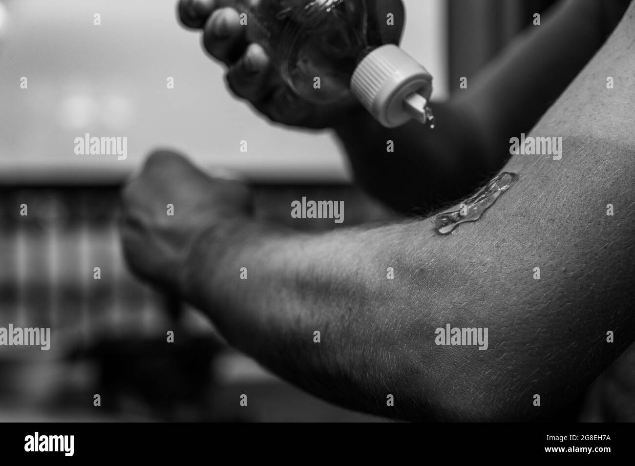 applying aloe vera gel to a red sunburn on an arm Stock Photo - Alamy