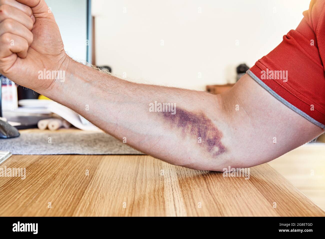Bruise On Forearm