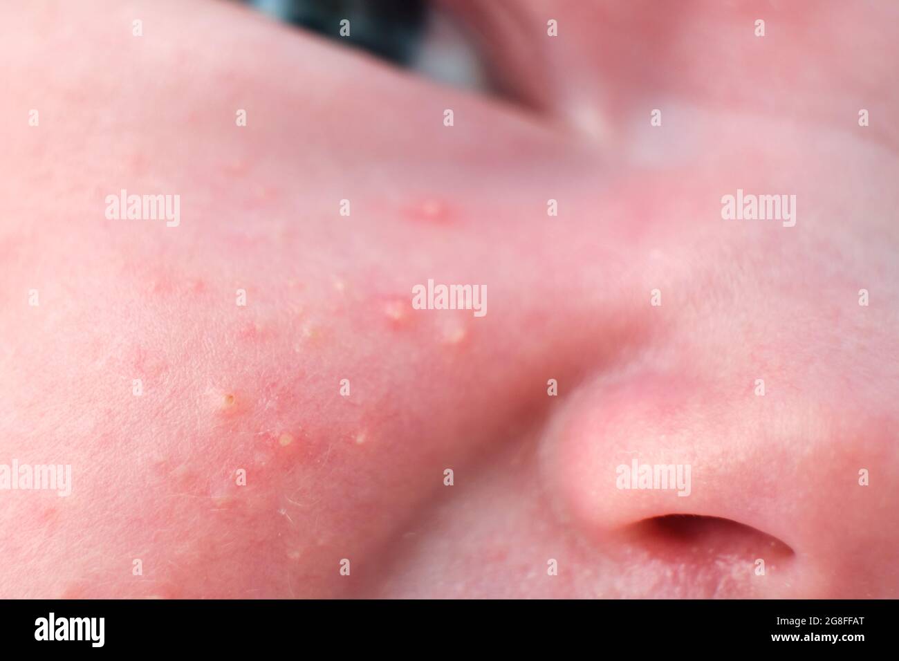 Acne on the face of a newborn child, close-up. Macro photos of skin ...