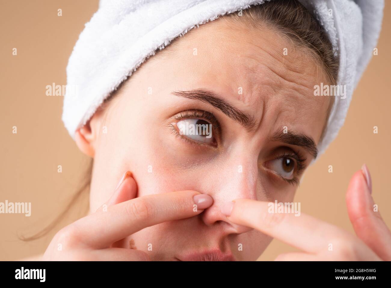 Woman close up face squeezing pimples. Acne blemish spots skin on young ...