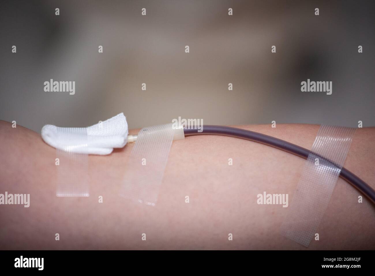 Arm of blood donator with needle and gauze in blood donation activity ...