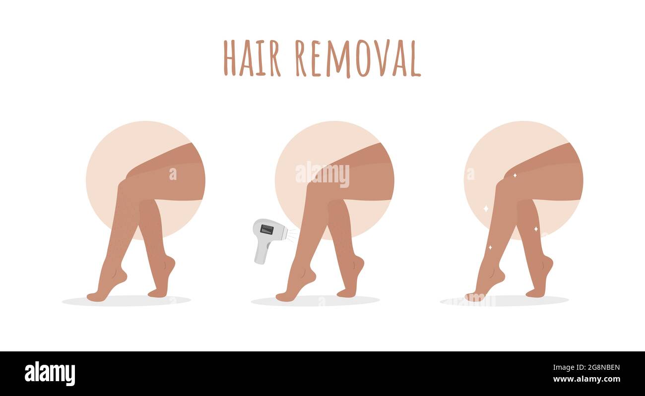 Hair removal. Laser epilation. Perfect smooth female legs. Before and ...