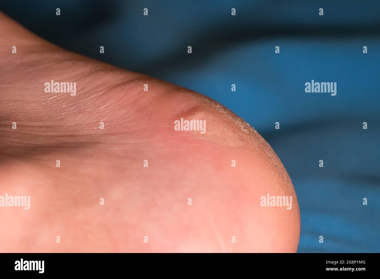 The outer side of the heel with a burst callus and dry skin. Close-up ...