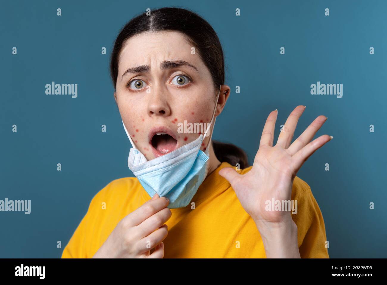 Woman acne vulgaris hi-res stock photography and images - Alamy