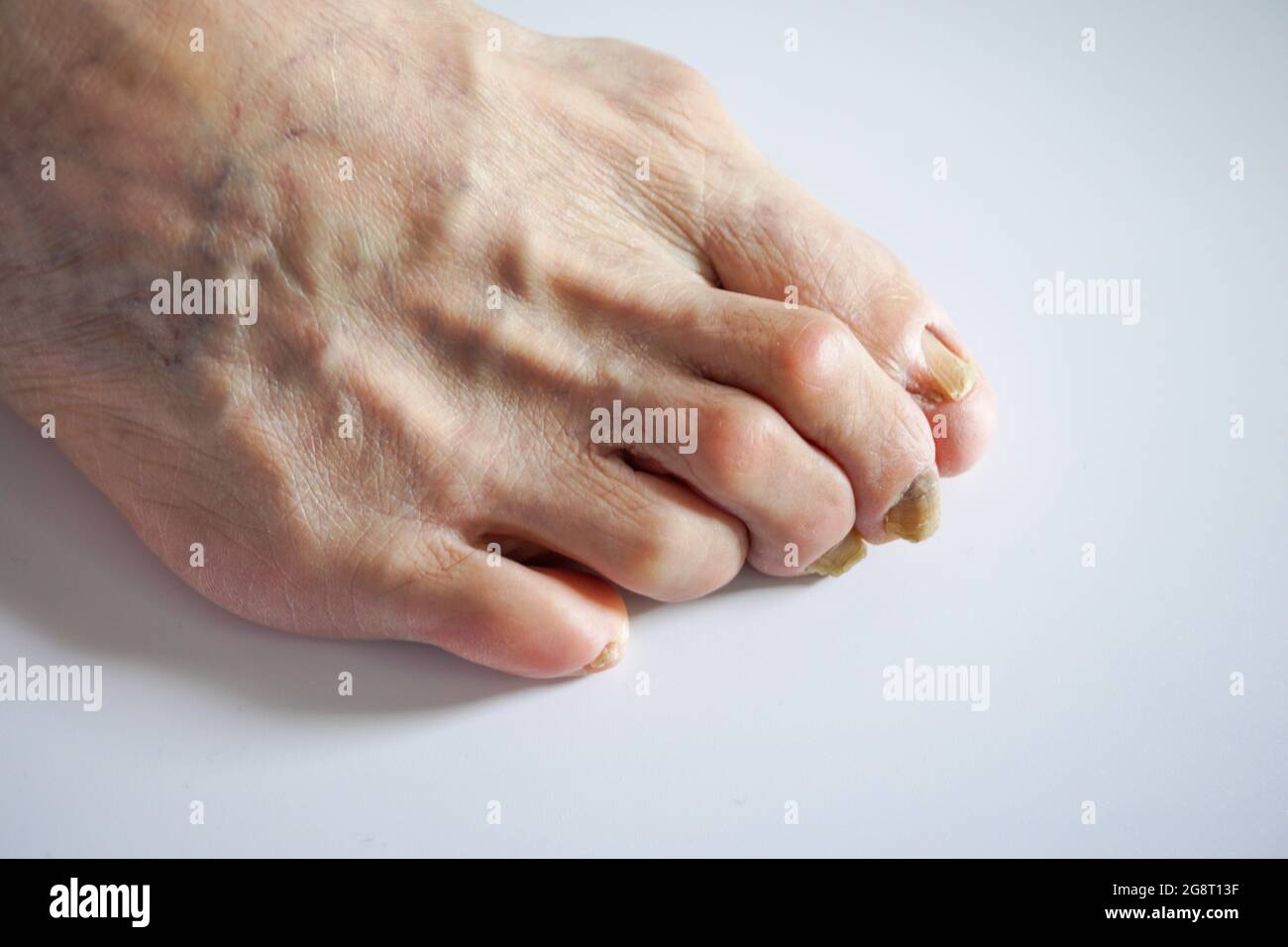Fungal Nail High Resolution Stock Photography and Images - Alamy