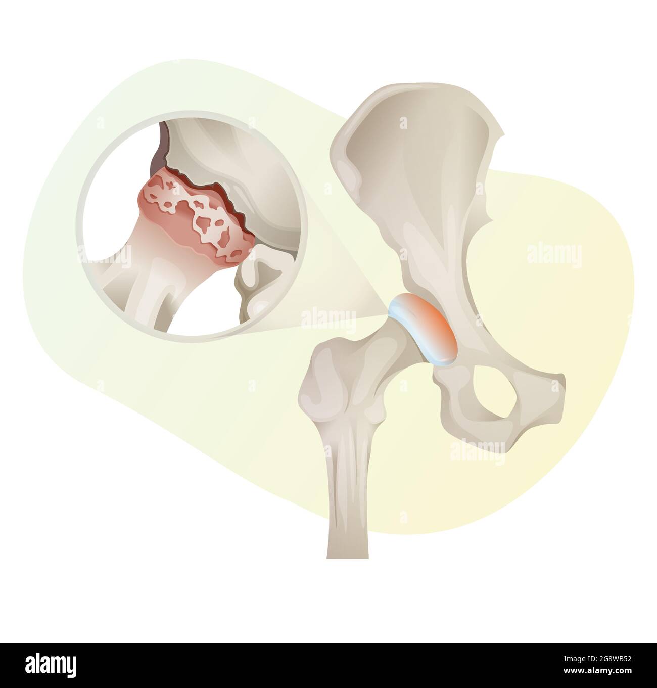 Osteoarthritis of the hip hi-res stock photography and images - Alamy