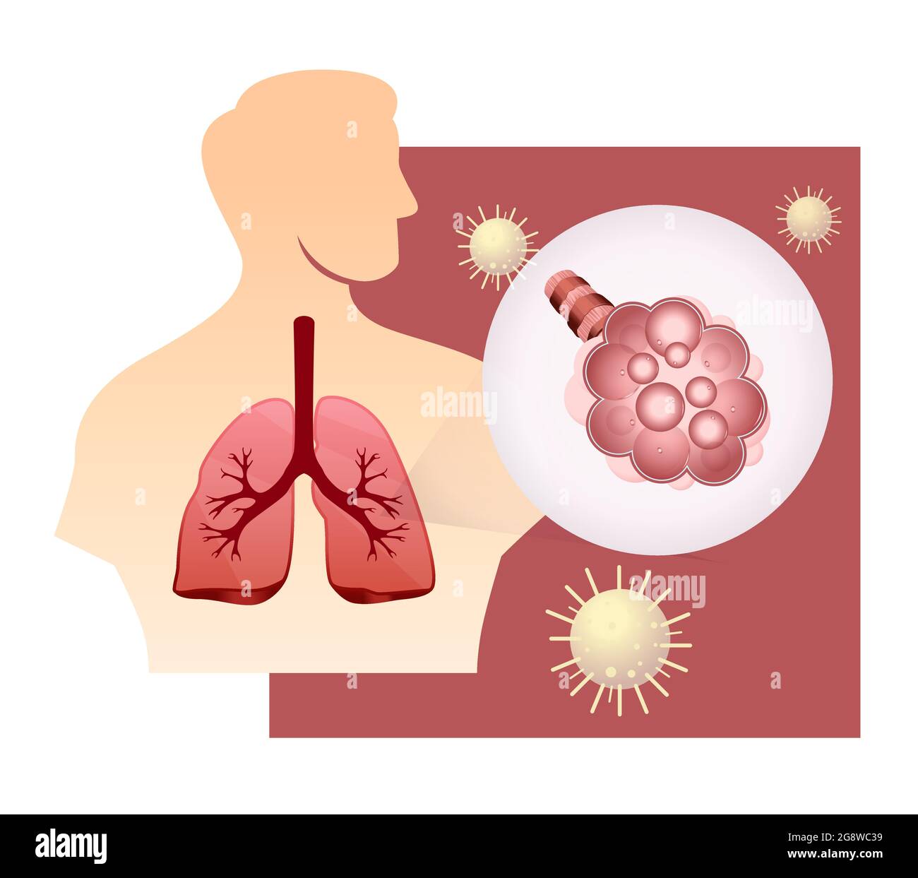 Edema vector vectors hi-res stock photography and images - Alamy