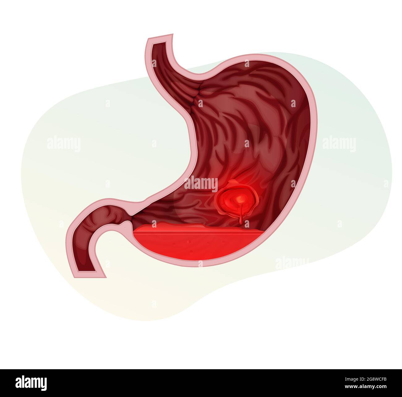 Human stomach with peptic ulcer hi-res stock photography and images - Alamy