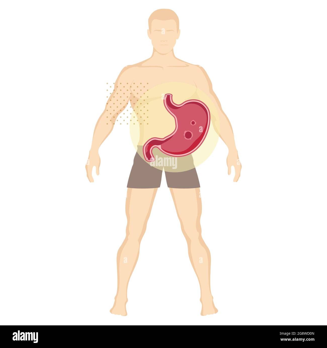 Human stomach with peptic ulcer hi-res stock photography and images - Alamy