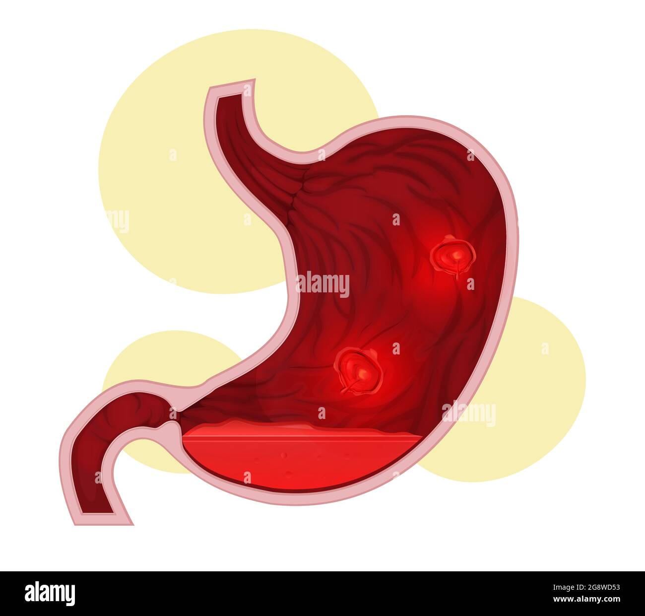 Peptic ulcer stomach hi-res stock photography and images - Alamy