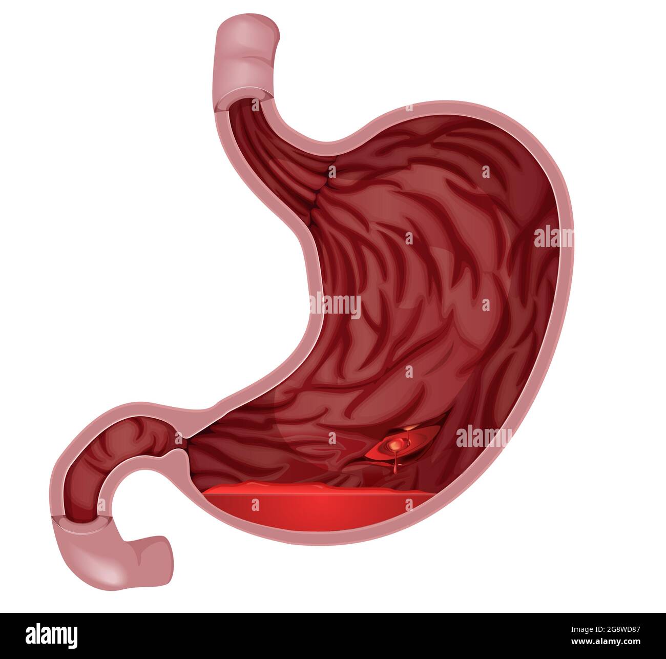 Human stomach with peptic ulcer hi-res stock photography and images - Alamy