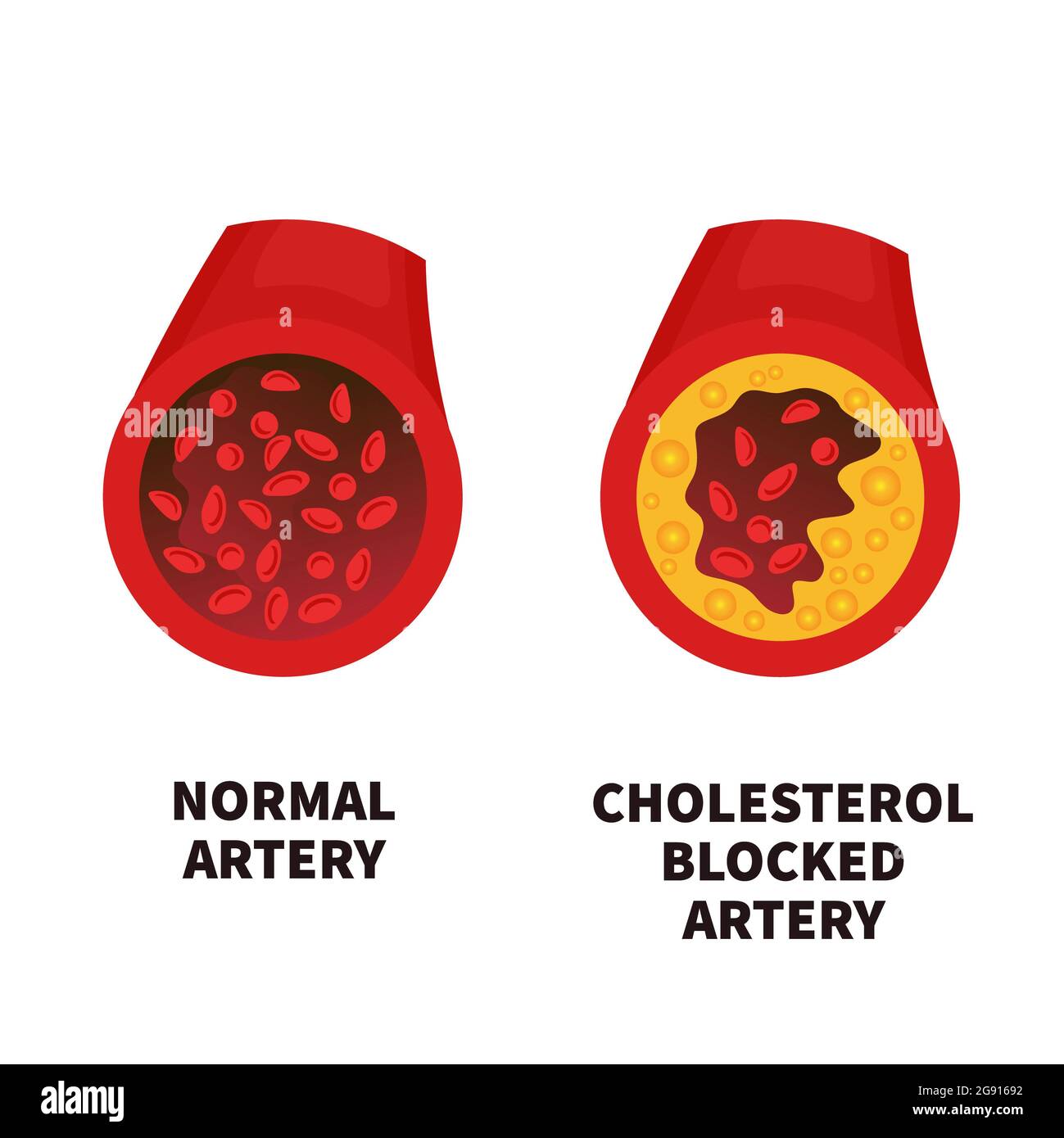 Hyperlipidaemia, conceptual illustration Stock Photo - Alamy
