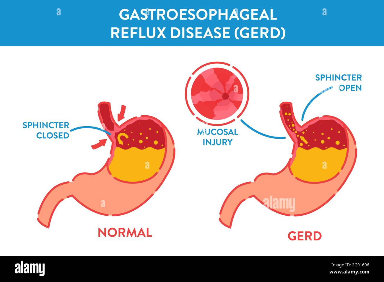 Gastroesophageal reflux disease, illustration Stock Photo - Alamy