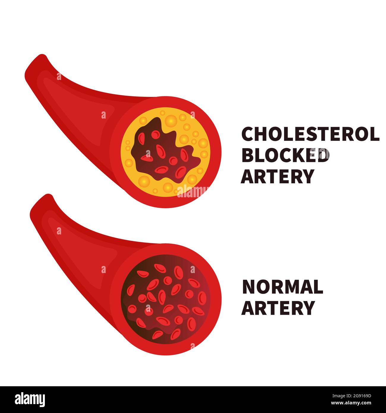 Lipoprotein High Resolution Stock Photography and Images - Alamy