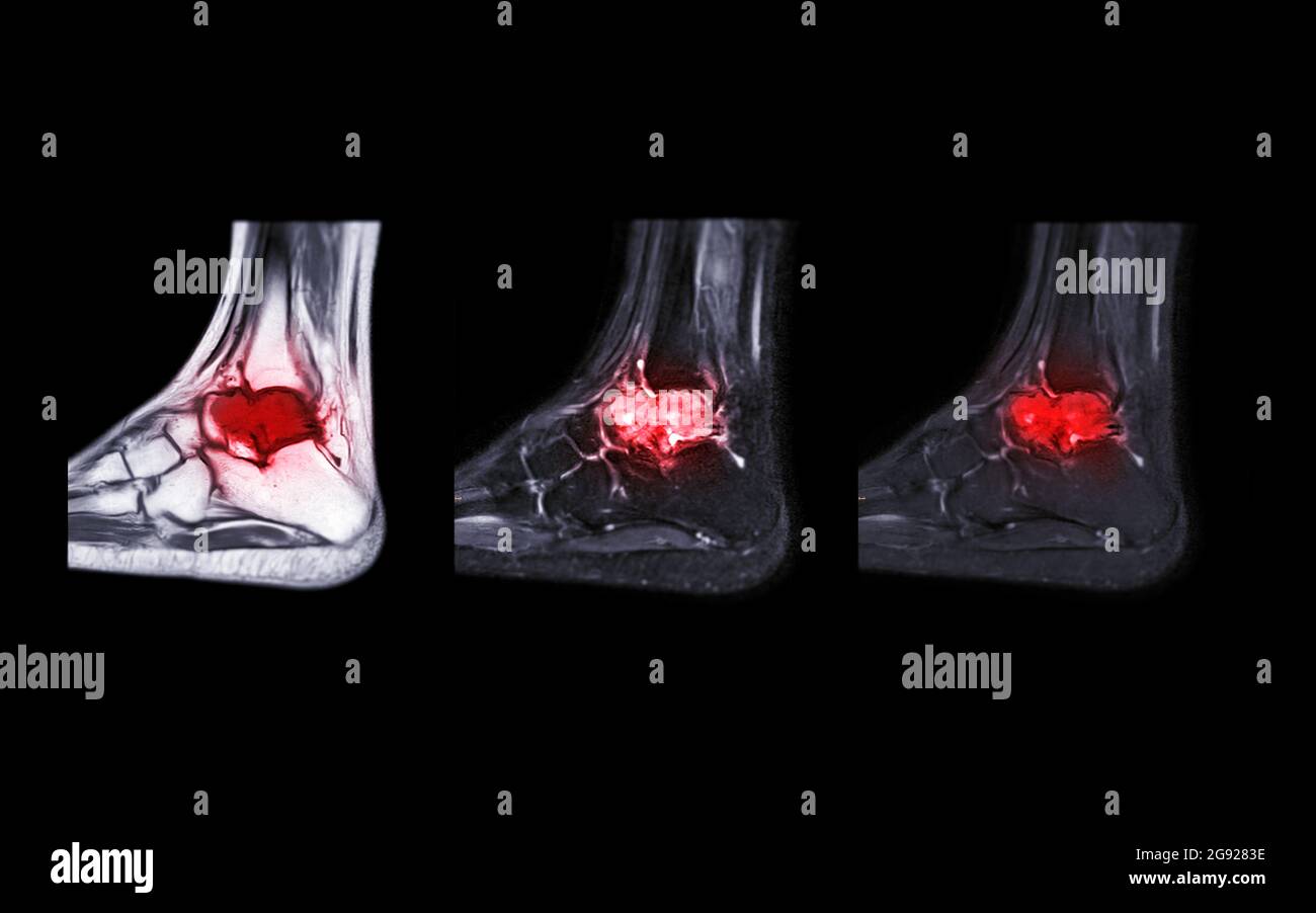 Compare of mri ankle joint sagittal view for diagnosis tendon of ankle ...