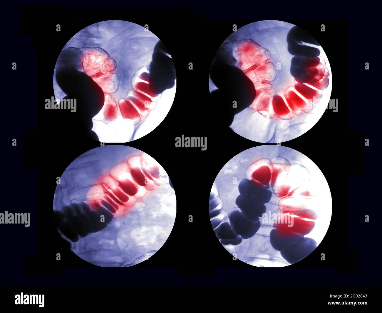 Barium enema large intestine hi-res stock photography and images - Alamy