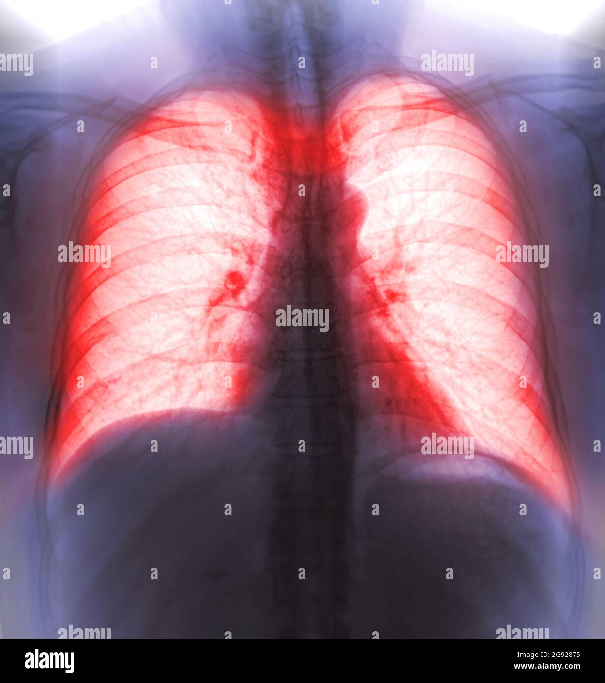 Chest X-ray or X-Ray Image Of Human Chest or Lung ( red zone ) showing ...