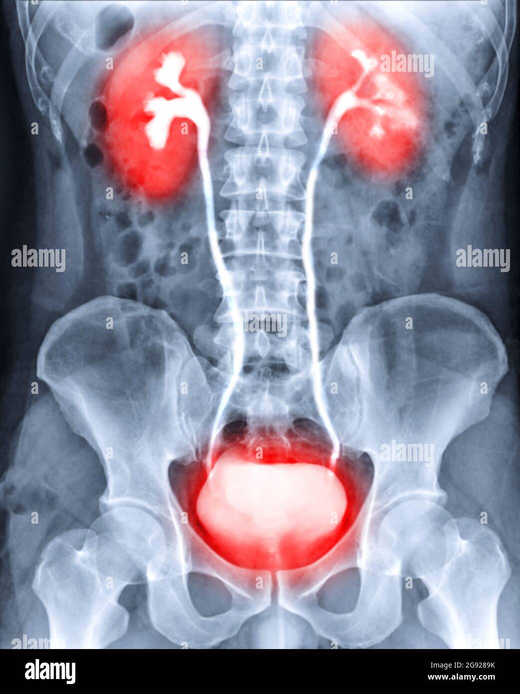 Intravenous pyelogram or I.V.P showing of urinary tract after injection ...