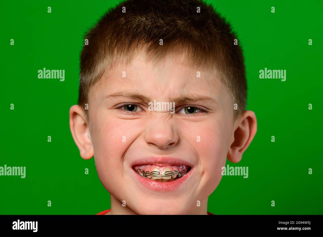 A boy of Caucasian nationality demonstrates a plate for straightening ...