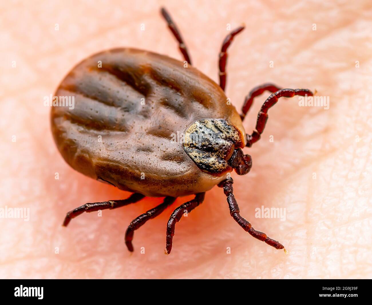 Encephalitis Tick Crawling on Skin. Encephalitis Virus or Lyme ...