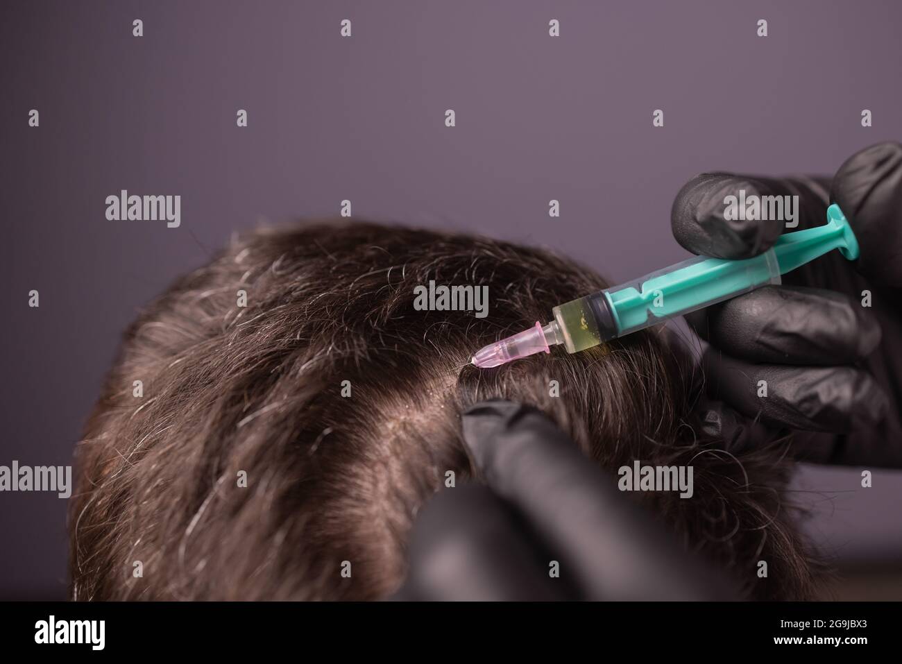 Mesotherapy for hair. Attractive man receiving injections in his head ...