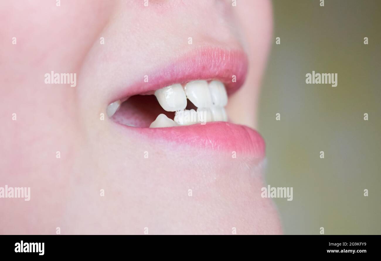 The child shows his teeth. One tooth is missing. Open mouth close-up ...