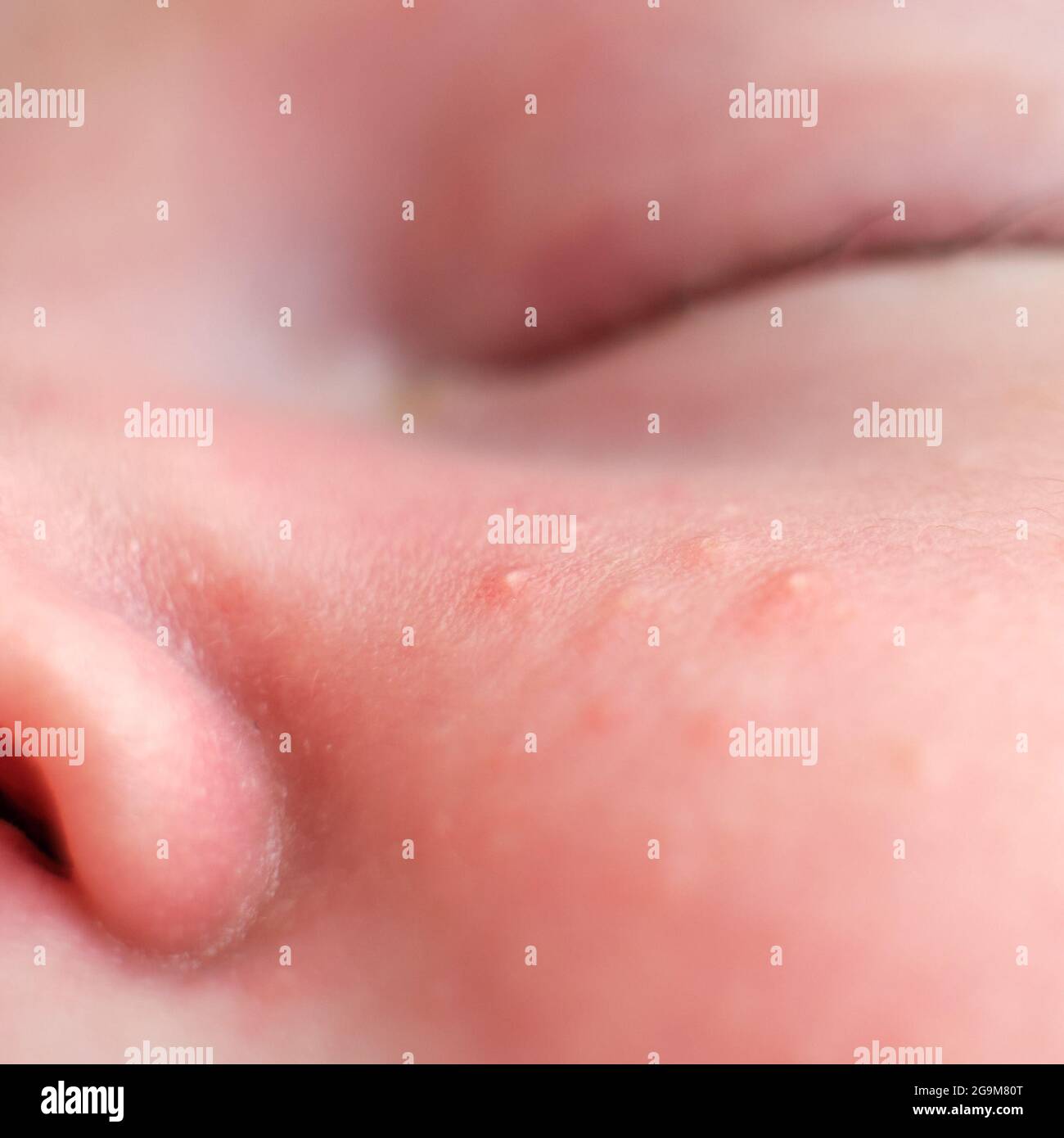 Acne on the face of a newborn child, close-up. Macro photos of skin ...