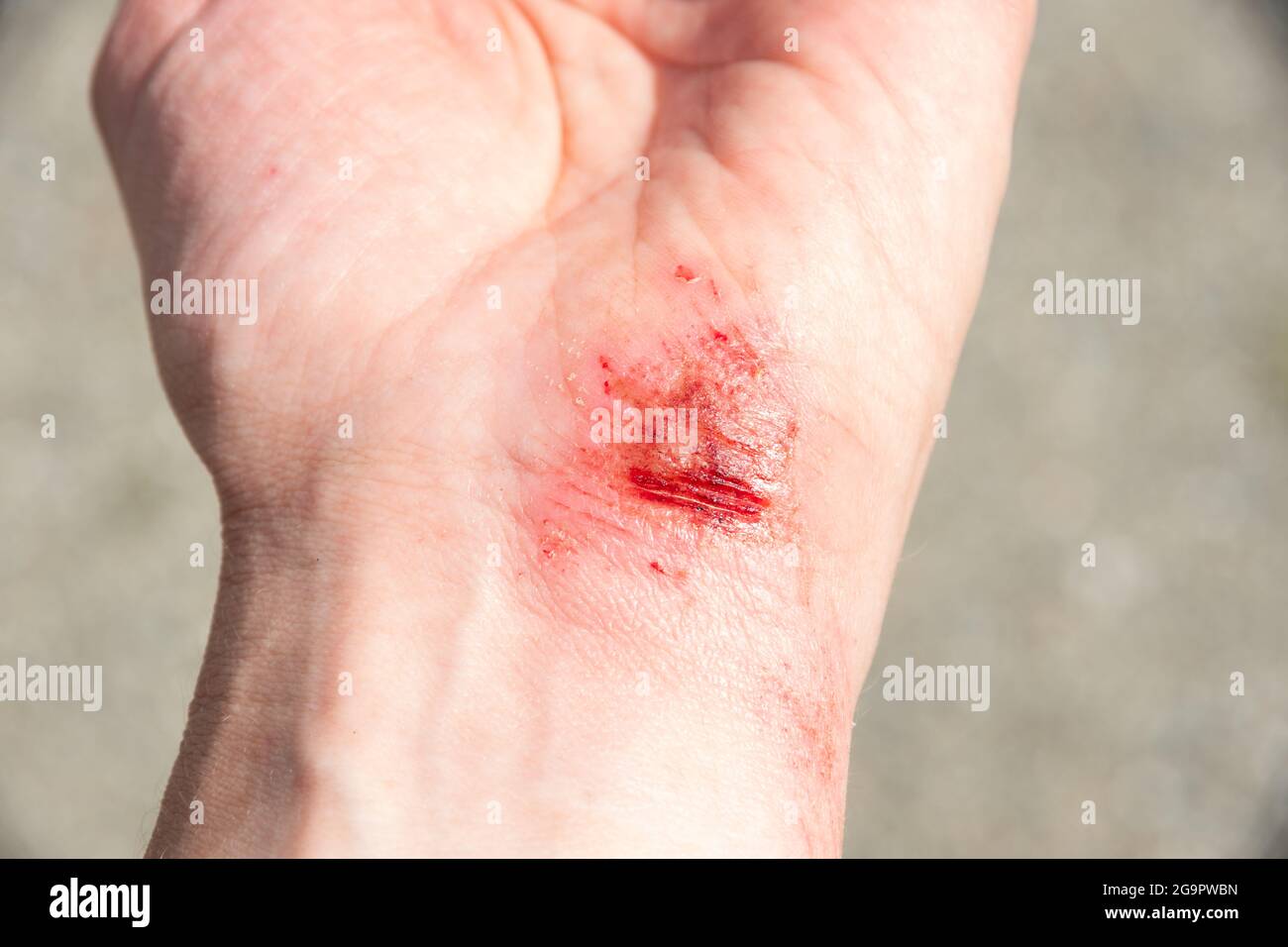 Bloody wound on the palm, arm, wrist after an accident or fall. Sport ...
