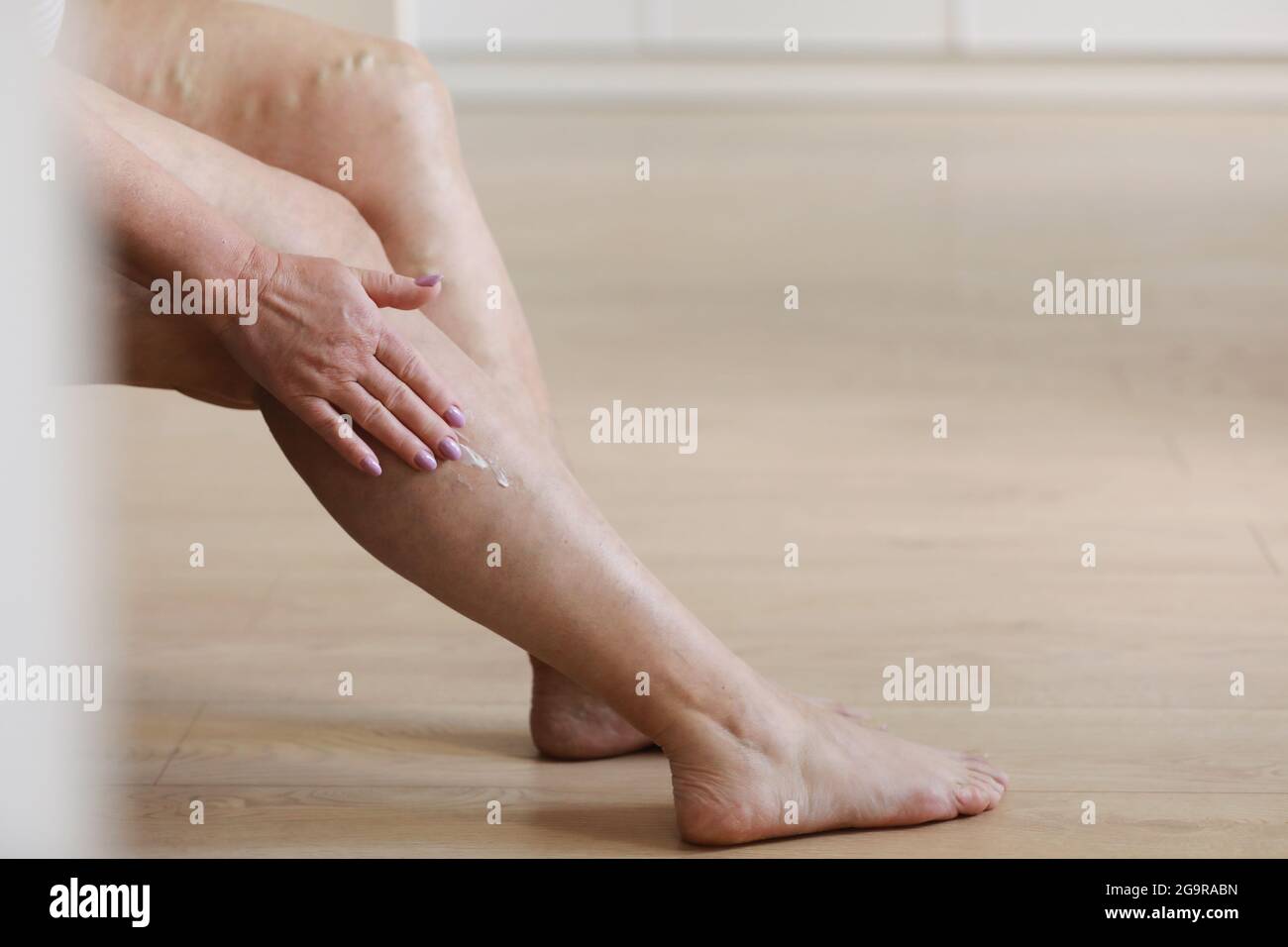 Painful varicose and spider veins on active womans legs, self-helping ...