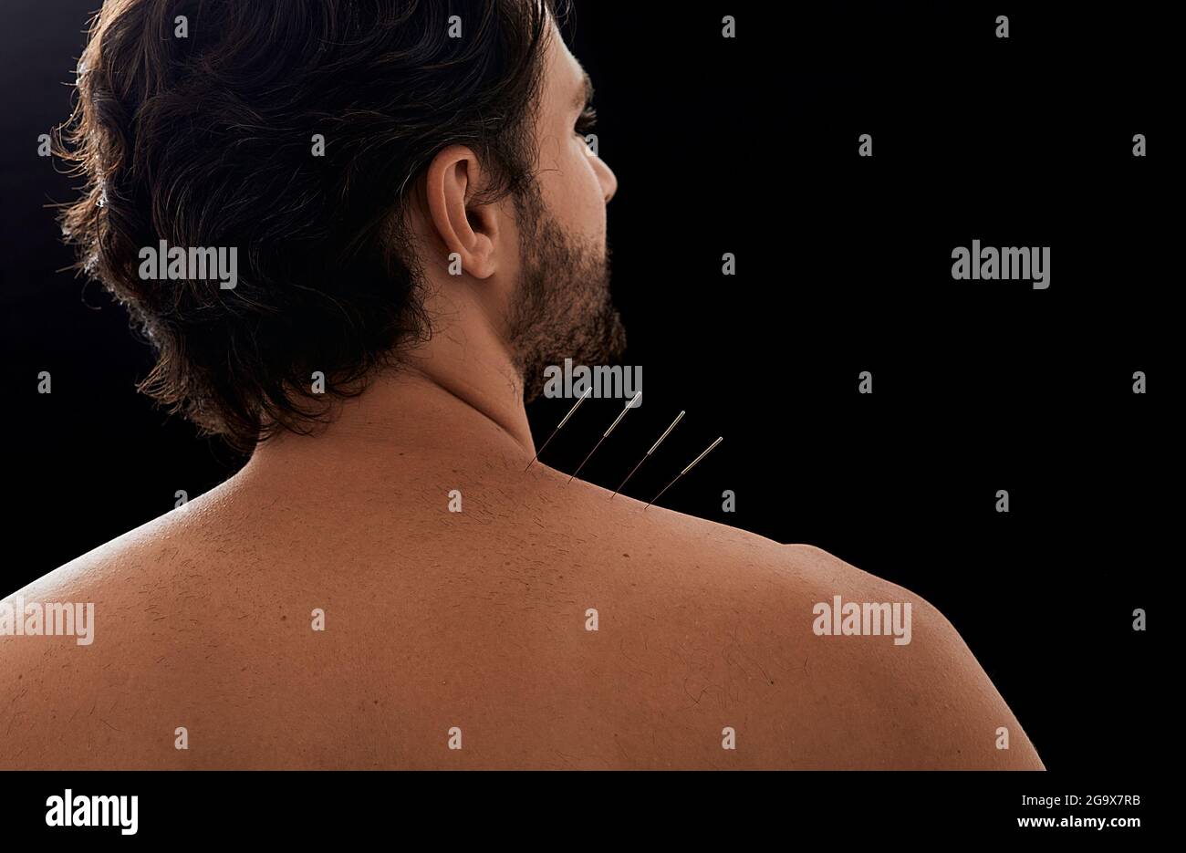 Acupuncture, reflexology. Close-up view from male patient back with ...