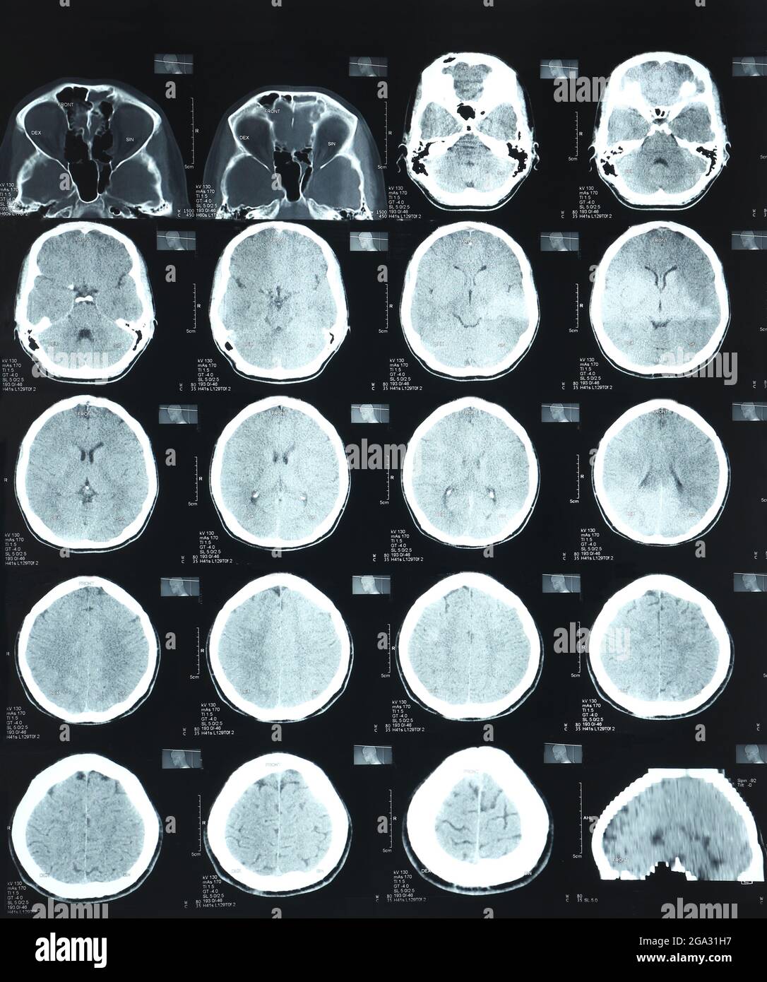 Human Joint X Ray Gray Background High Resolution Stock Photography and ...